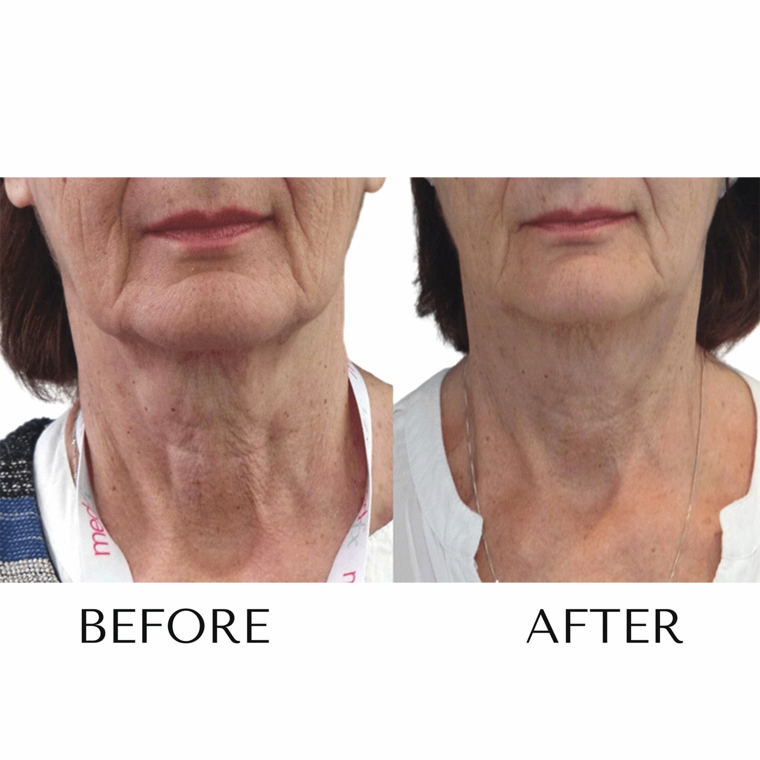 Crepe Skin Miracle Chin & Neck Firming Cream | Dr. Leonard's