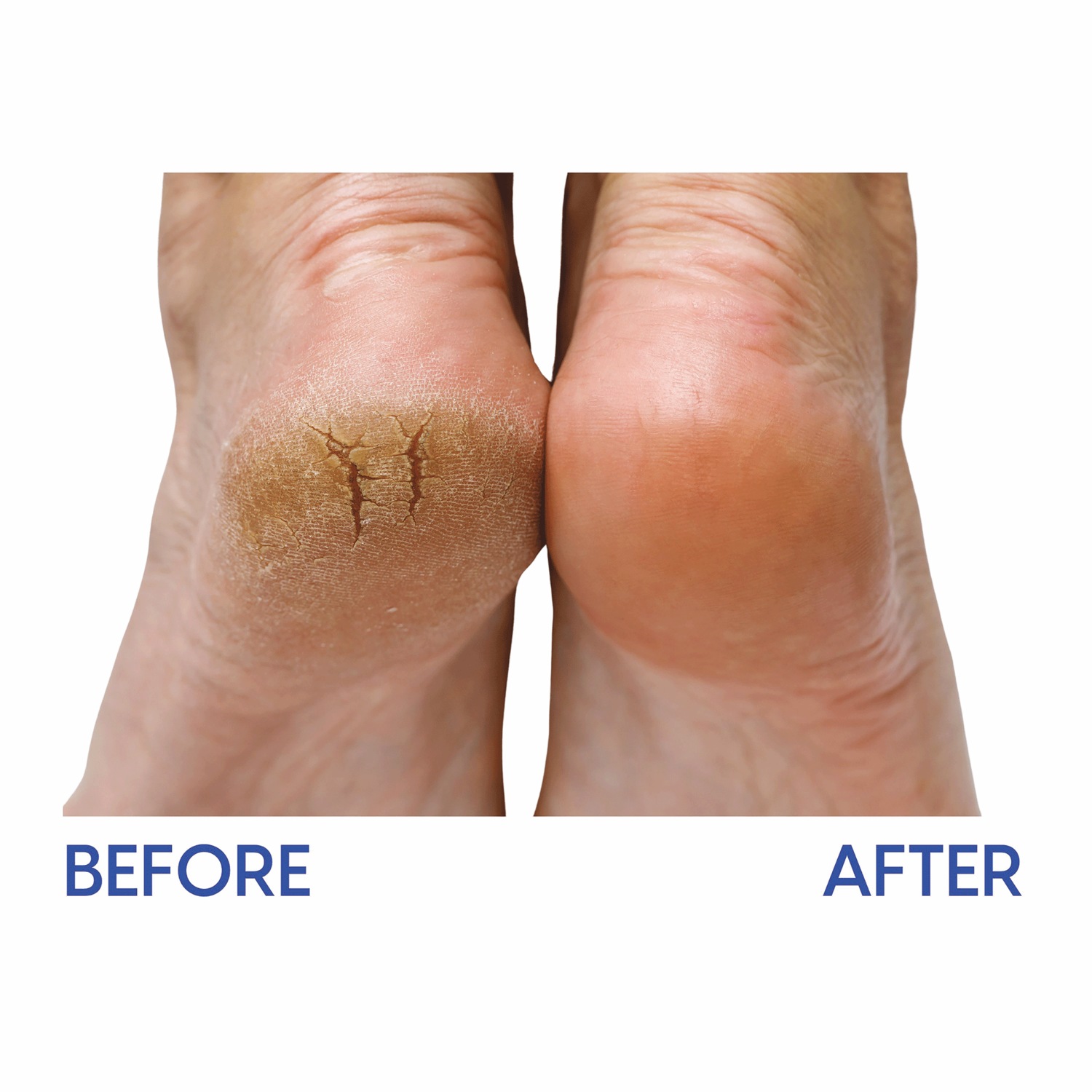Relief Now Diabetic Dry Skin Relief Foot Cream | Dr. Leonard's